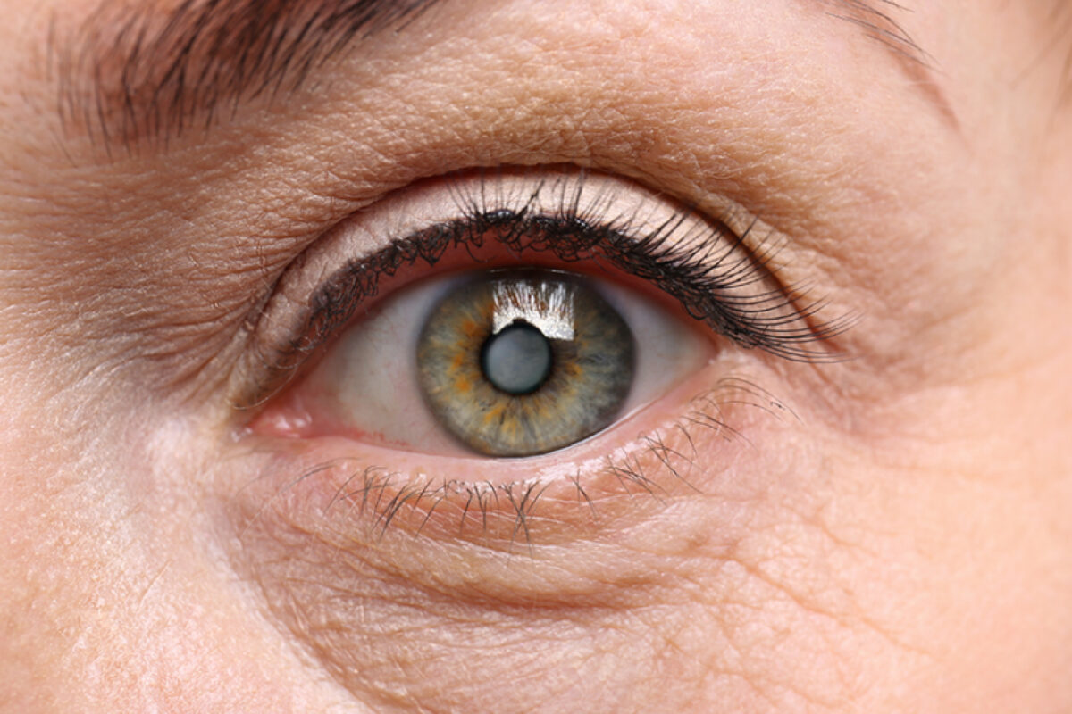 Cataract Surgery - Lopamudra Drishti Eye Hospital